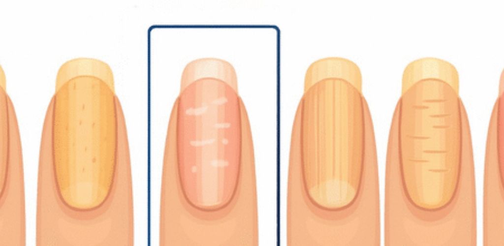 Del color a la textura: qué revelan los cambios en las uñas sobre tu ...